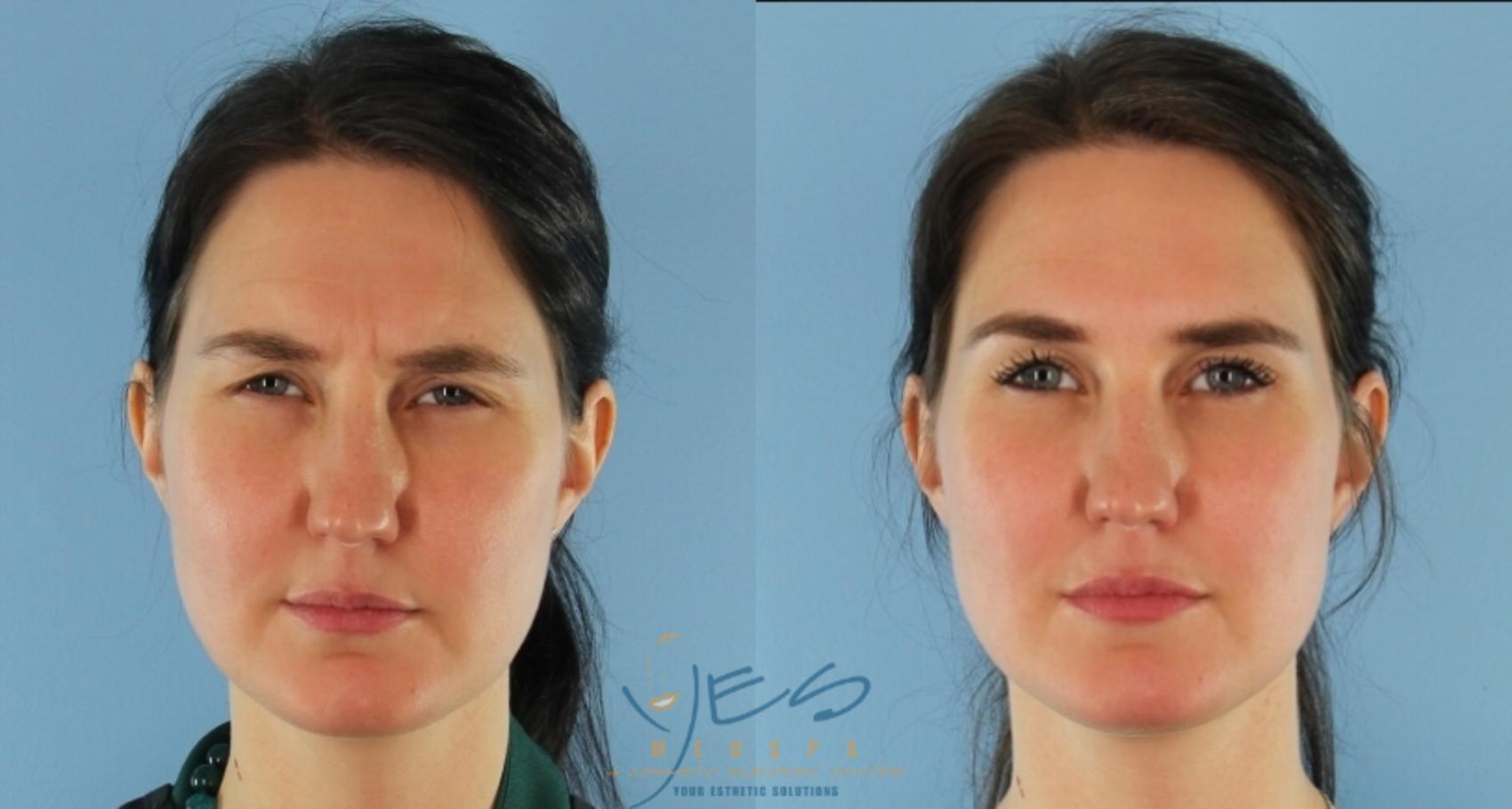 Patient Before & After - Dermal Fillers & BOTOX COSMETICS® Treatment