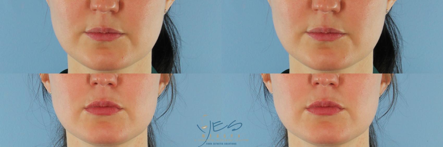 Patient Before & After - Dermal Fillers & BOTOX COSMETICS® Treatment