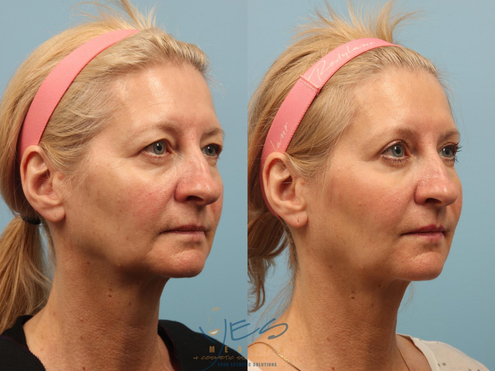 Brow Lift Before & After Photos Patient 259 | Vancouver, BC | YES ...