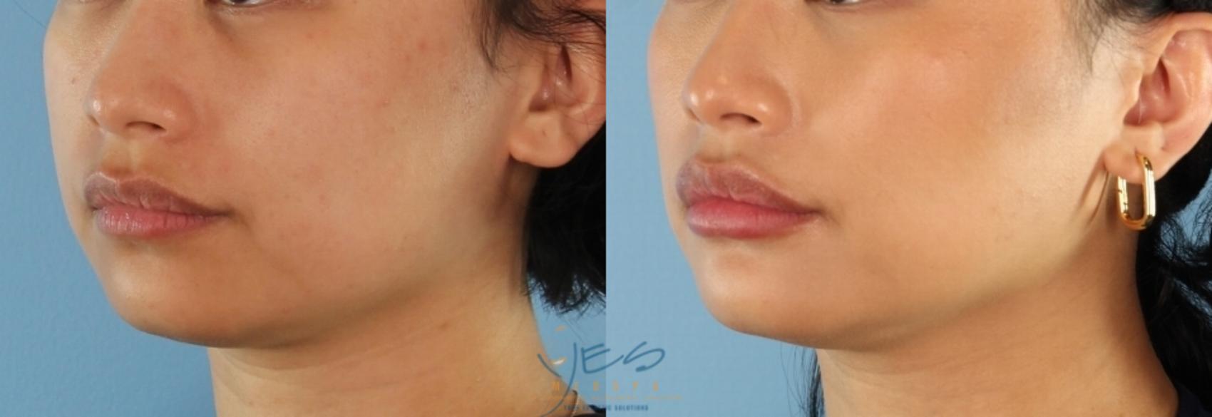 Dermal Fillers Before & After Photos Patient 461 | Vancouver, BC | YES ...