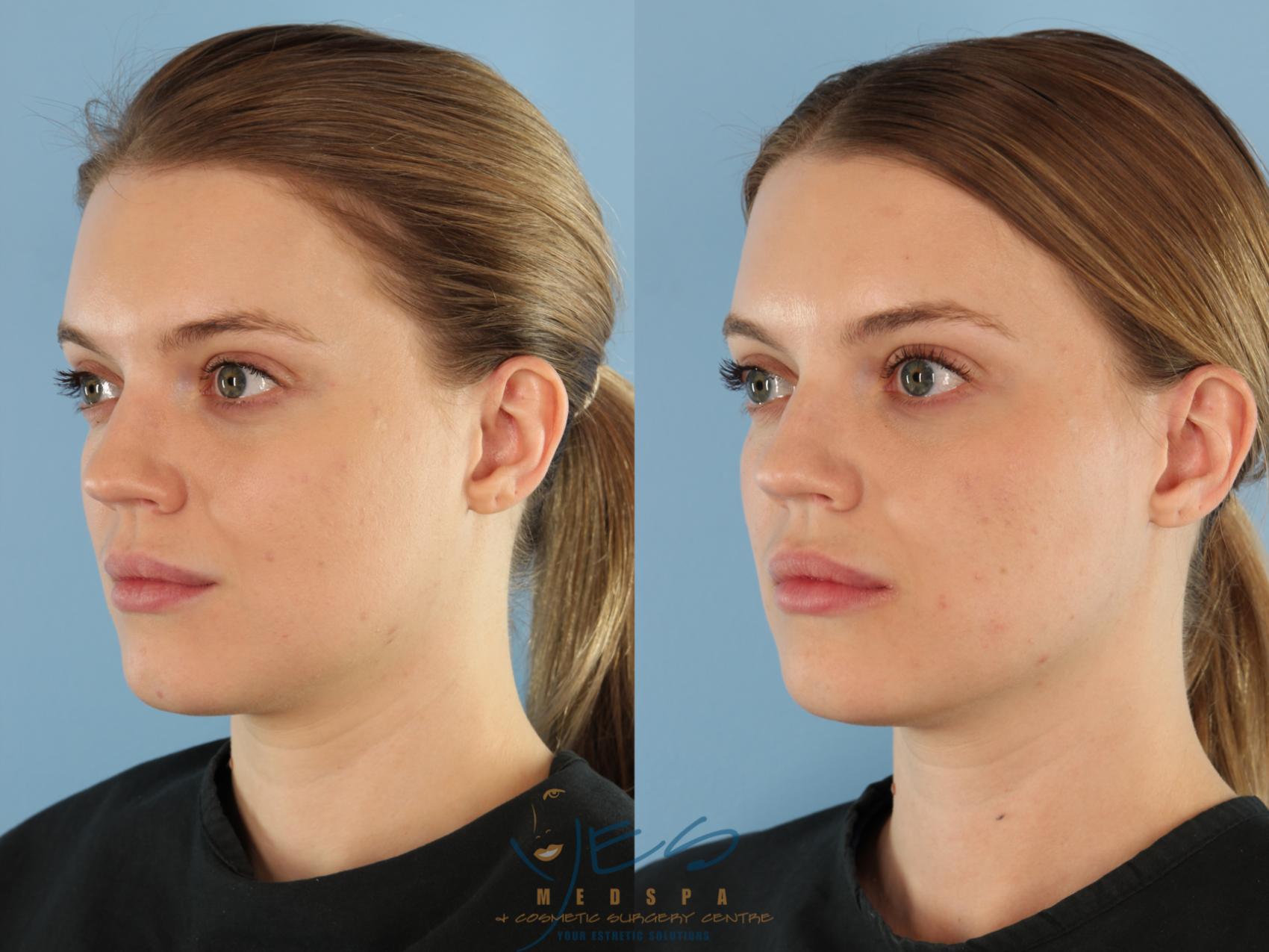 Dermal Fillers Before & After Photos Patient 535 | Vancouver, BC | YES ...