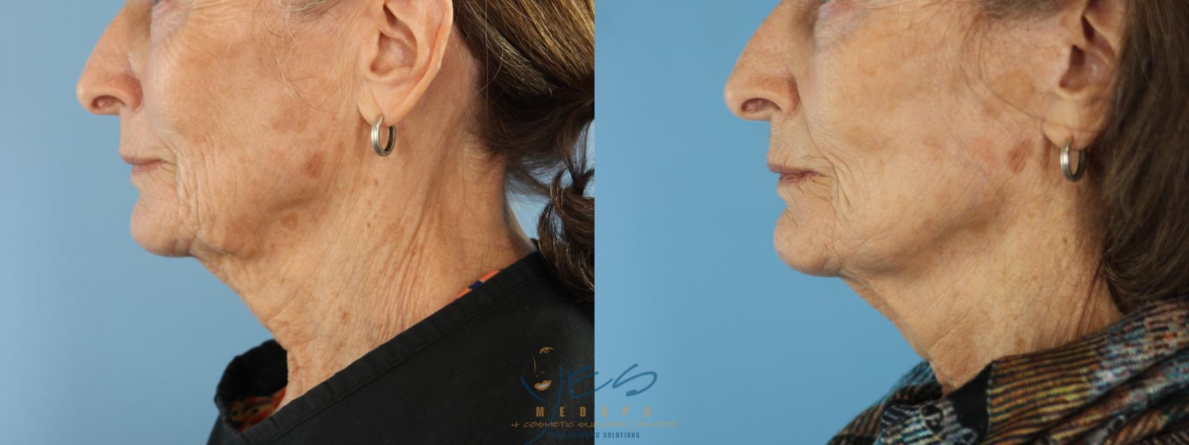 Face Lift & Neck Lift Before & After Photos Patient 537 | Vancouver, BC ...