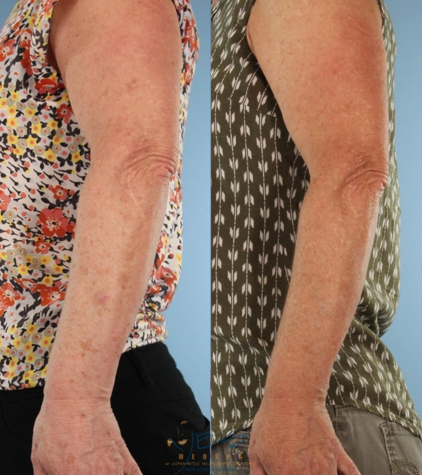 Patient Before & After - PhotoBody Treatment - Full Arms